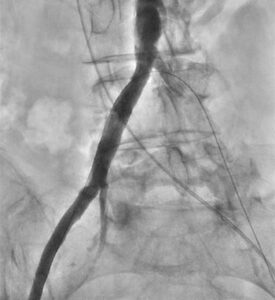 Implante TAVI para una paciente con estenosis aórtica - Siprotec