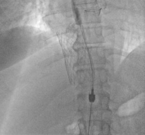 Caso Clínico Tricvalve - Siprotec